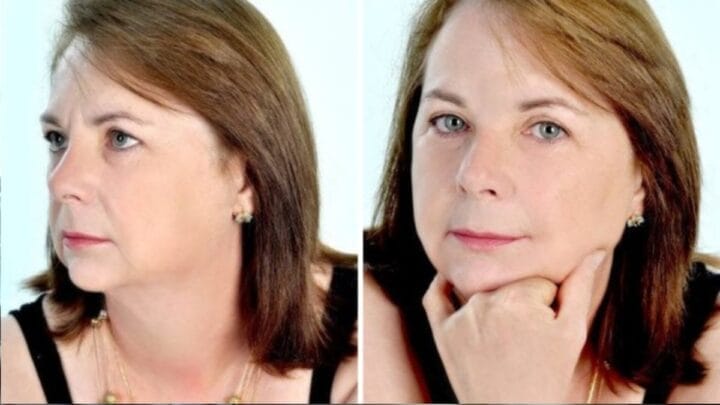 Em alta no Brasil, lifting facial está entre os procedimentos ...